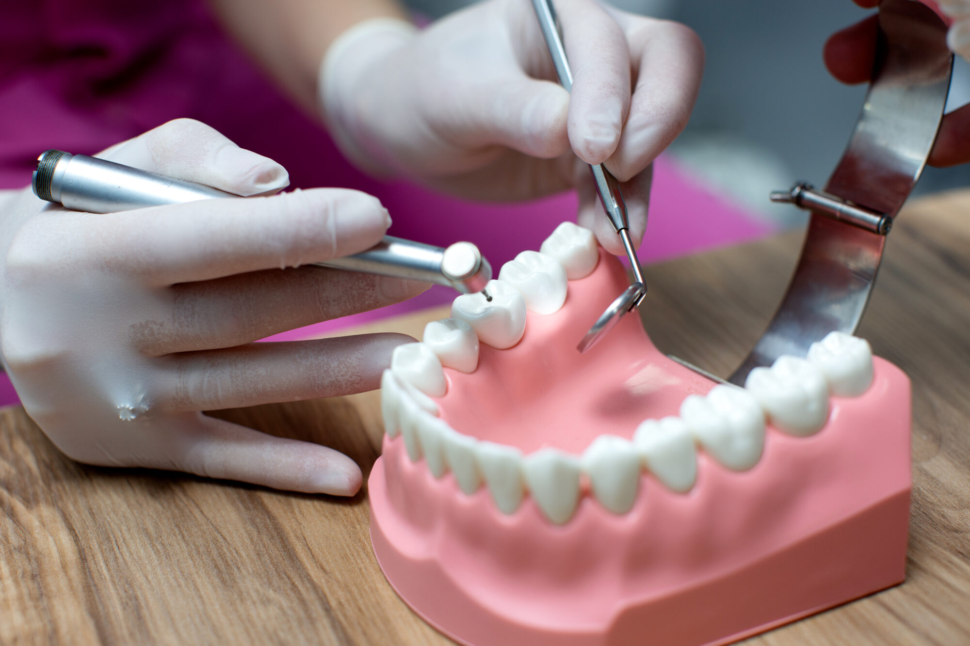 Porcelain Inlays & Onlays Explained: A Modern Alternative to Fillings